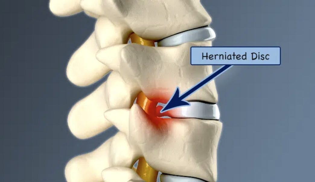 A Guide to Understanding Herniated Discs and Associated Complications ...